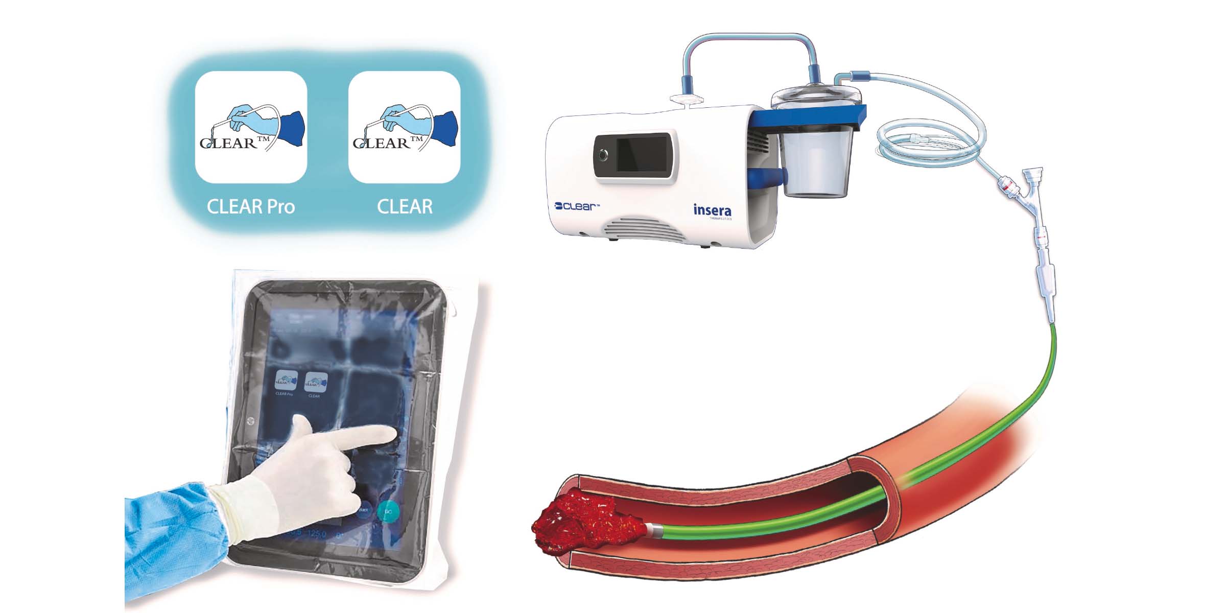 First two patients treated with cyclical aspiration system CLEAR – BIBA ...