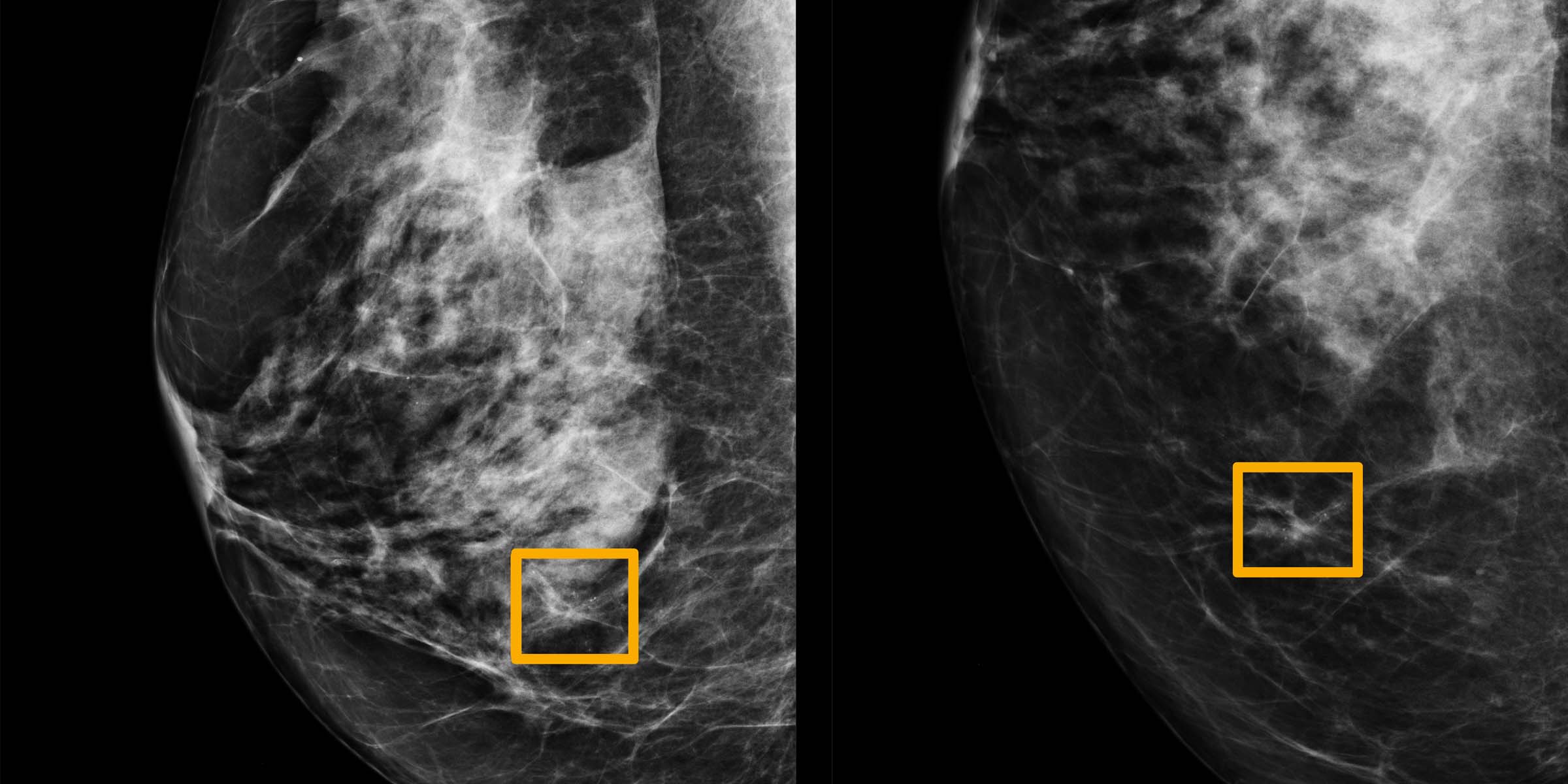 Ai System Shows Promise For Improving Accuracy And Efficiency Of Breast